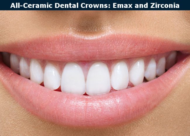 All Ceramic Crowns Burbank - My Dentist Burbank
