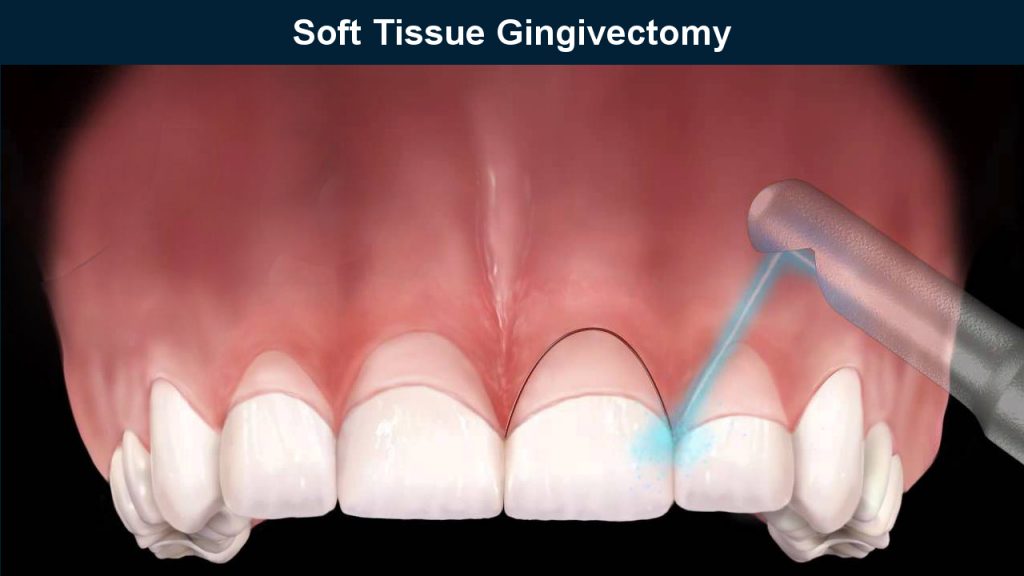 Soft Tissue Gingivectomy Burbank My Dentist Burbank