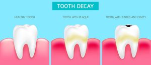 Tooth Decay Causes, Stages and Prevention - My Dentist Burbank