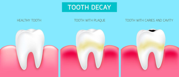 Tooth Decay Causes, Stages and Prevention - My Dentist Burbank