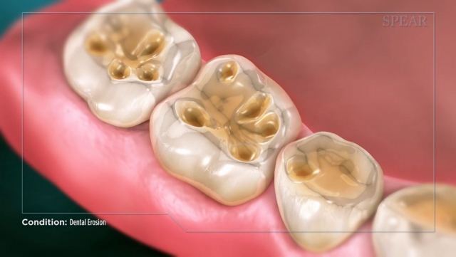 Dental Erosion: Causes and Treatment - My Dentist Burbank