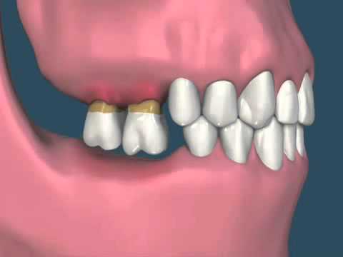 Consequences of Tooth Loss - My Dentist Burbank