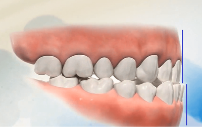 Dental Bite and Its Effect on the Face Shape | My Dentist Burbank