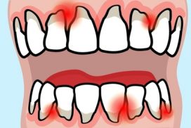 Sore Gums: Symptoms, Signs, Causes & Treatment - My Dentist Burbank