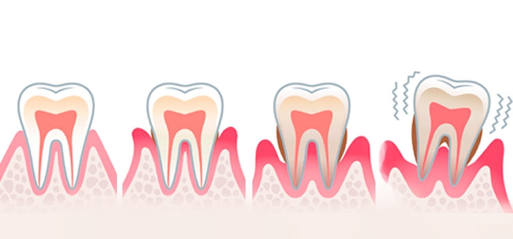 Tooth Mobility and Periodontal Therapy | My Dentist Burbank