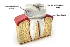 Smooth Surface Cavities - My Dentist Burbank