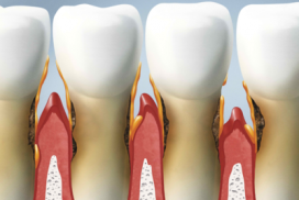 Root Decay in Your Later Years Could Endanger Your Teeth - My Dentist ...
