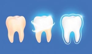 What Causes Lack of Enamel? | My Dentist Burbank