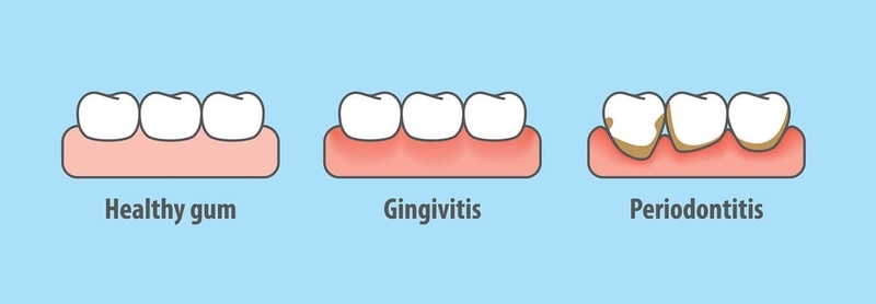 Six Signs of Unhealthy Gum - My Dentist Burbank