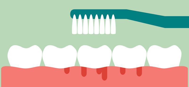 Why You Shouldn't Ignore Blood When Brushing? - My Dentist Burbank