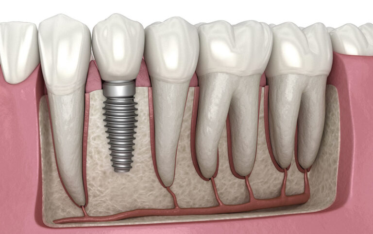 How Bone Loss Affects Dental Implants - My Dentist Burbank