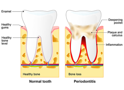 Furcation Defect Treatment - My Dentist Burbank
