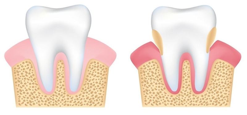 Furcation Defect Treatment - My Dentist Burbank