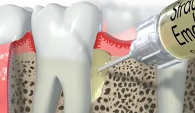 Furcation Defect Treatment - My Dentist Burbank