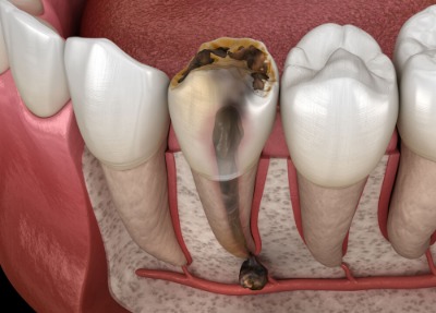 Can A Dead Tooth Be Saved: Causes, Signs, Symptoms & Treatment - My ...