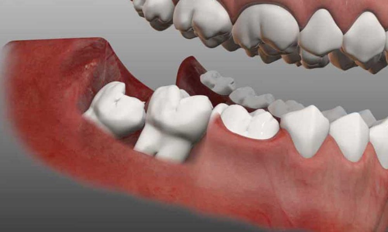 wisdom teeth - My Dentist Burbank